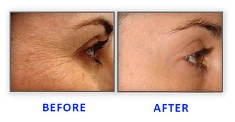 Crystalift Renew Labdermasante