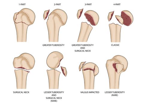 Humerus Bone Fracture