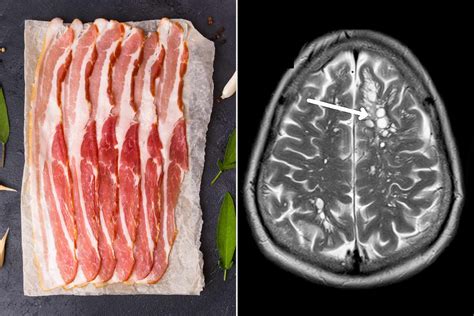 Worm Eggs In Mans Brain Caused By Undercooked Bacon