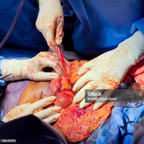 Doctors Doing Exploratory Laparotomy Surgery In A Patient With Intestinal Polyposis Syndrome