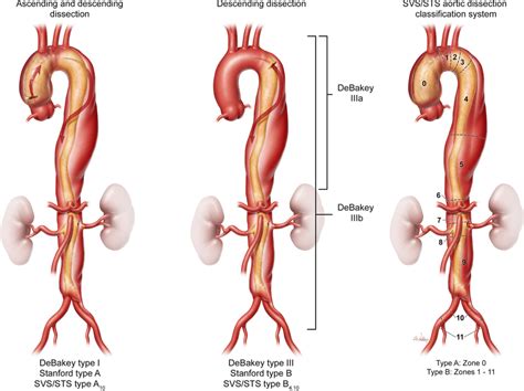 An Illustration Of Classification Systems For Aortic Dissection Download Scientific Diagram