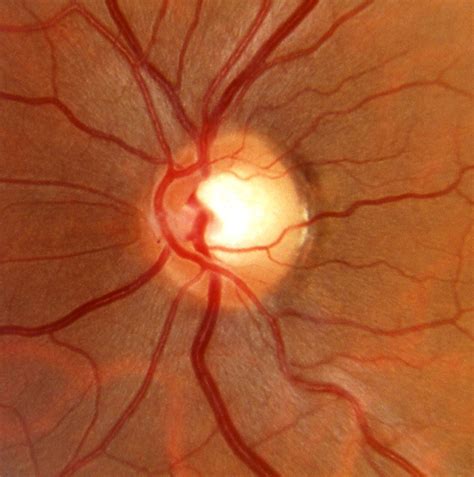 Optic Nerve Glaucoma