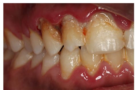 Necrotizing Ulcerative Gingivitis