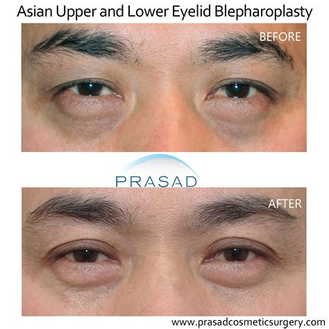 Single Eyelid Vs Double Eyelid