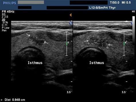Papillary Thyroid Cancer Ultrasound Colors Warehouse Of Ideas