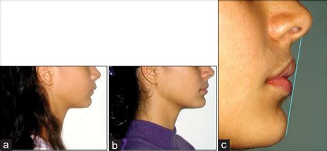 Braces Before And After Side Profile