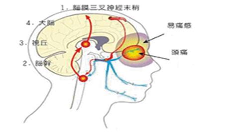 偏头痛的症状图片 偏头痛图片大全 偏头痛 39疾病百科
