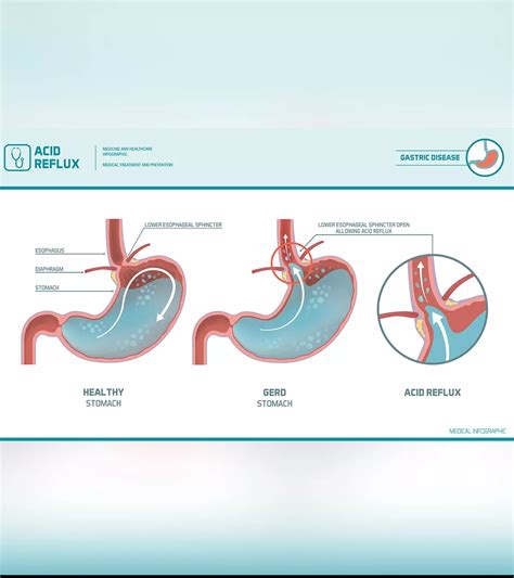 Heartburn In Teens Causes Symptoms And Treatment