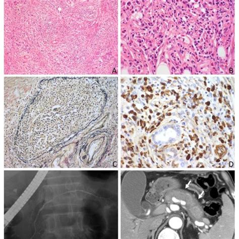 Histological And Radiological Features Of Type 1 Aip A Pancreas Is