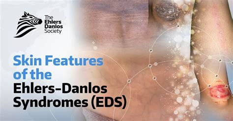 Skin Dermatology Ehlersdanlossyndrome Scarring The Ehlers Danlos
