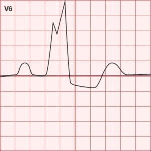 Left Bundle Branch Block Part Differential Diagnosis Of