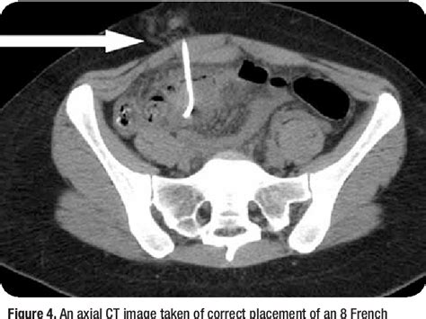 Figure 4 From Ct Guided Percutaneous Drainage Of Appendix Abscess Semantic Scholar