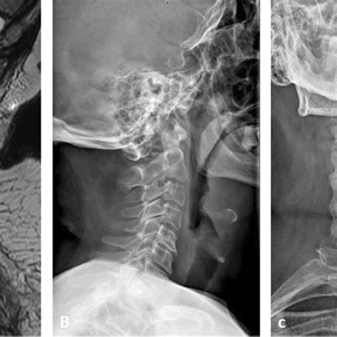 A Sagittal Mri T2 Sequence A And A Lateral B And Anteroposterior