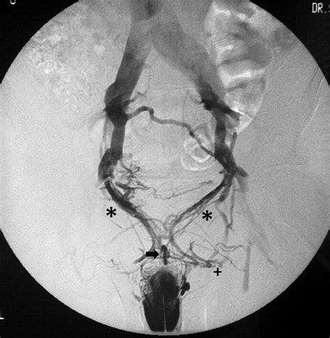 Embolization Of The Periprostatic Venous Plexus For Erectile