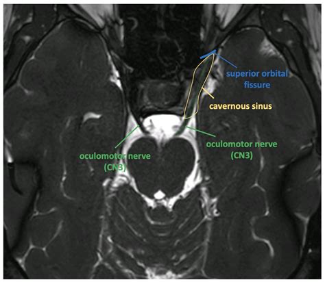 A Reminder To All Radres On Their First Neurorad Rotation In The