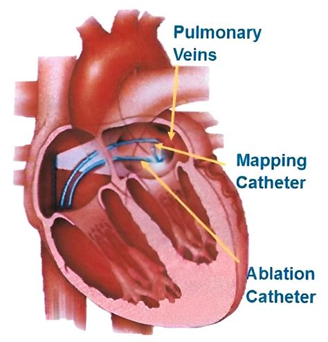 Pulmonary Vein Isolation Pensinsula Cardiology Group