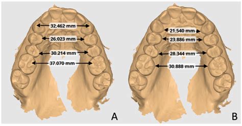Linear Measurements Between Selected Points On Sample Digital Model Of Download Scientific