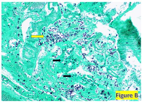 Cryptococcus Histology