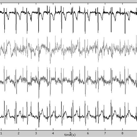 The Hexaxial Reference System Note That The Position Of Each Limb Lead