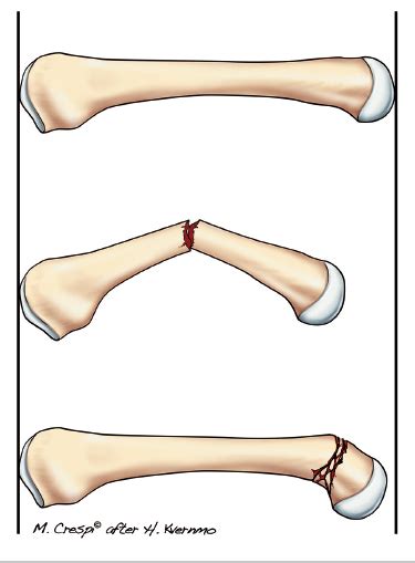 Metacarpal Neck Fractures Musculoskeletal Key
