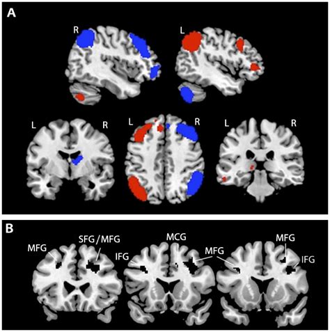 Aberrant Amygdala Functional Connectivity At Rest In Pediatric Anxiety Disorders Biology Of Mood