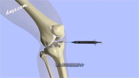膝关节注射技术 高清1080P在线观看平台 腾讯视频