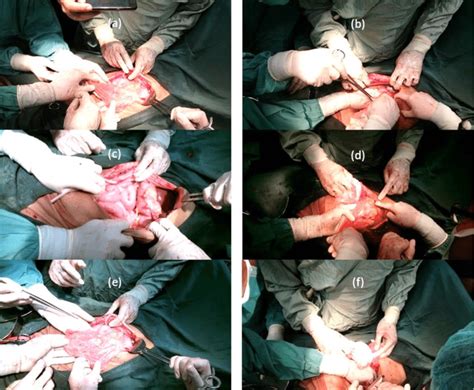 Exploratory Laparotomy A First Insicion B Omental Opening C Download Scientific Diagram