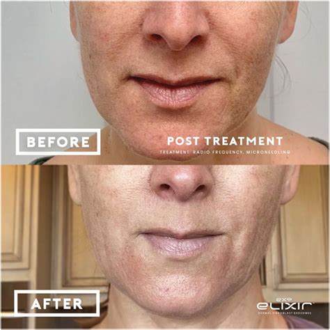 Microneedling With Exosomes Before And After Pictures