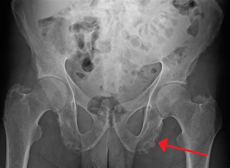 Enthesopathy Wikipedia