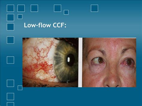 Ppt Differential Diagnosis Of Orbital Disease Powerpoint Presentation Id 2224086