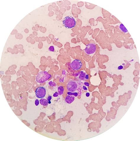 Eritroblastos Vacuolados En Una Paciente Con Vih E Infecciones Oportunistas Revista Médico