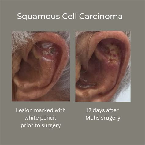 Squamous Cell Carcinoma Treatment Common And Curable