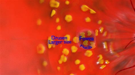 Artstation Age Related Macular Degeneration Amd Armd Resources