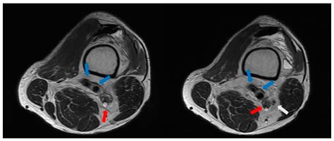 Palsy Of Both The Tibial Nerve And Common Peroneal Nerve Caused By A