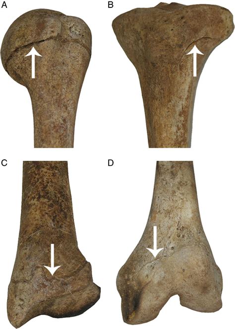 Skeletal Age Parameters Represented By The Fusion Of Humerus Tibia