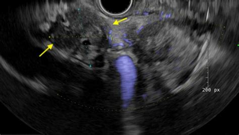 Endoscopic Ultrasound Showing An Enlarged Lymph Node Arrows