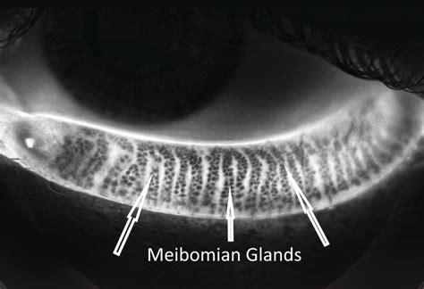 Meibomian Gland Dysfunction