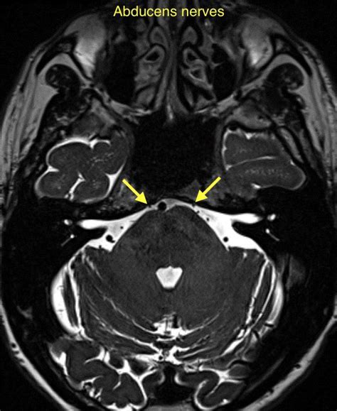 Imaging Quick Tips And Tricks For Cranial Neuropathies 🧠 A Neuroimaging 🧵