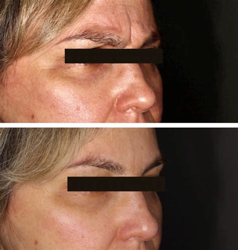 Frown And Forehead Lines Gallery Beautech Cosmetic Frown And Forehead Lines Gallery Beautech Cosmetic