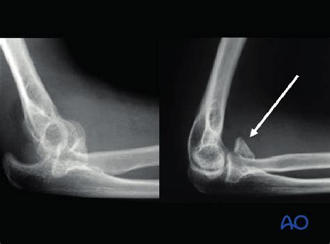 Repair Of Coronoid Fracture For Ulna Articular Coronoid