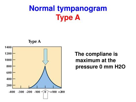 Type C Tympanogram Causes At Mickey Munos Blog
