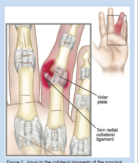 Top 104 Pictures Ring Finger Torn Ligament In Finger Pictures Superb