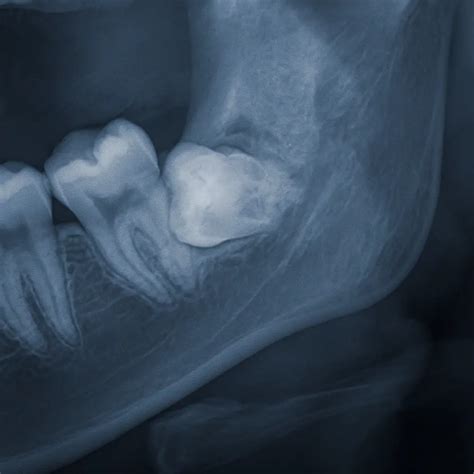 Wisdom Tooth Infection Symptoms Signs Risks And Treatment
