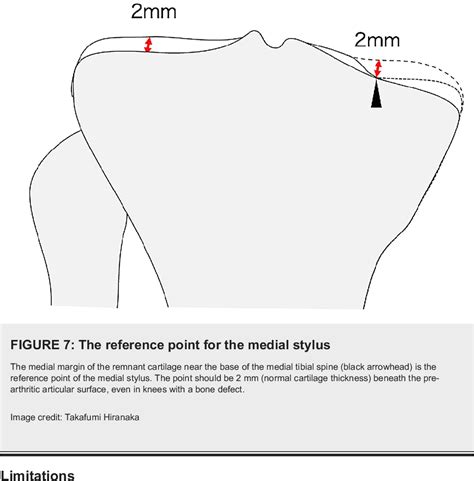 Figure 7 From Caliper Based Restricted Kinematic Alignment Total Knee