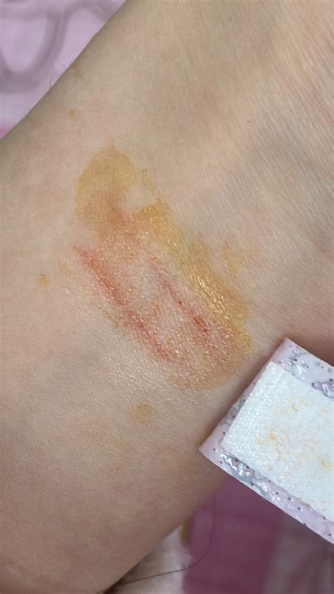 손톱으로 긁힌 상처 흉터 지식in