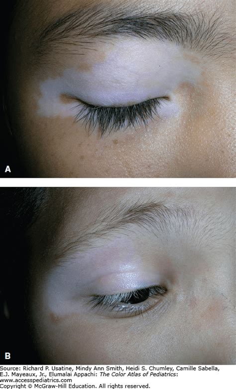 Vitiligo And Hypopigmentation Obgyn Key