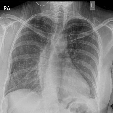 What Is An Artifact On An X Ray At Buddy Franzen Blog
