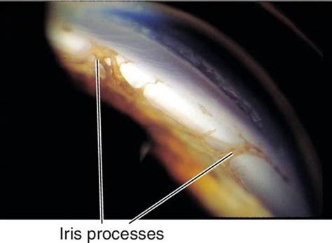 Iris Processes Gonioscopy Angle