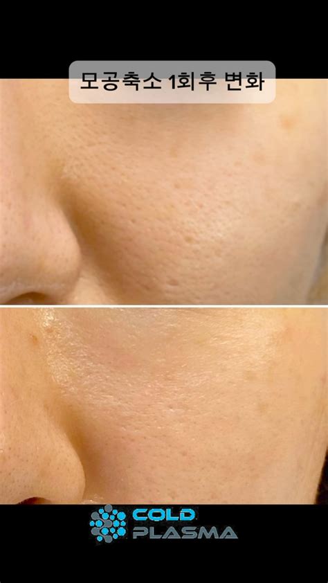 플라즈마 콜드플라즈마 종로플라즈마 플라즈마교육인증기관 교육 시술문의 플라즈마종로 콜드플라즈마종로 동대문플라즈마 턱선 리프팅 Ai플라 다운타임 확실히줄이고 효과는