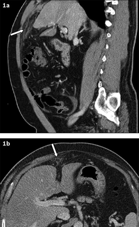 A Sagittal And B Axial Contrast Enhanced Ct Image Of The Abdomen